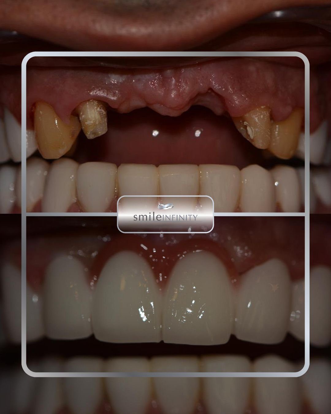 Dental Implants Beirut Lebanon | Dr. Habib Zarifeh