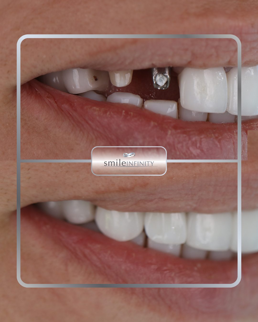 Dental Implants Beirut Lebanon | Dr. Habib Zarifeh