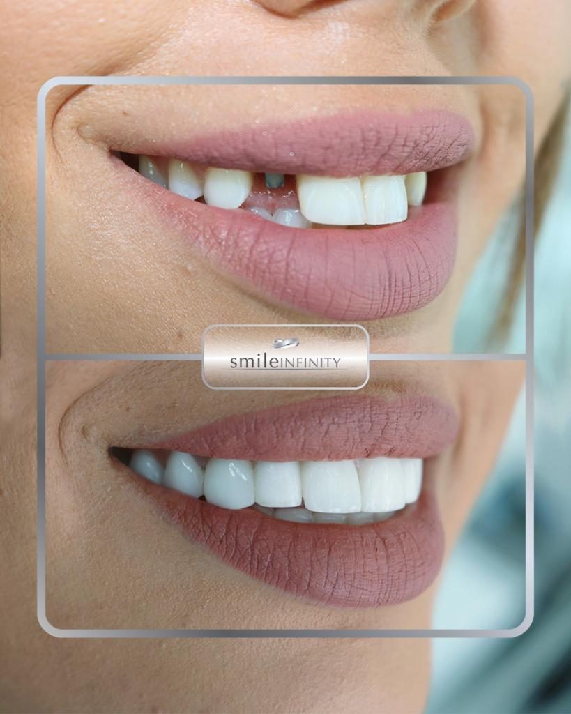 Hollywood Smile Beirut — Before & After | Dr. Habib Zarifeh